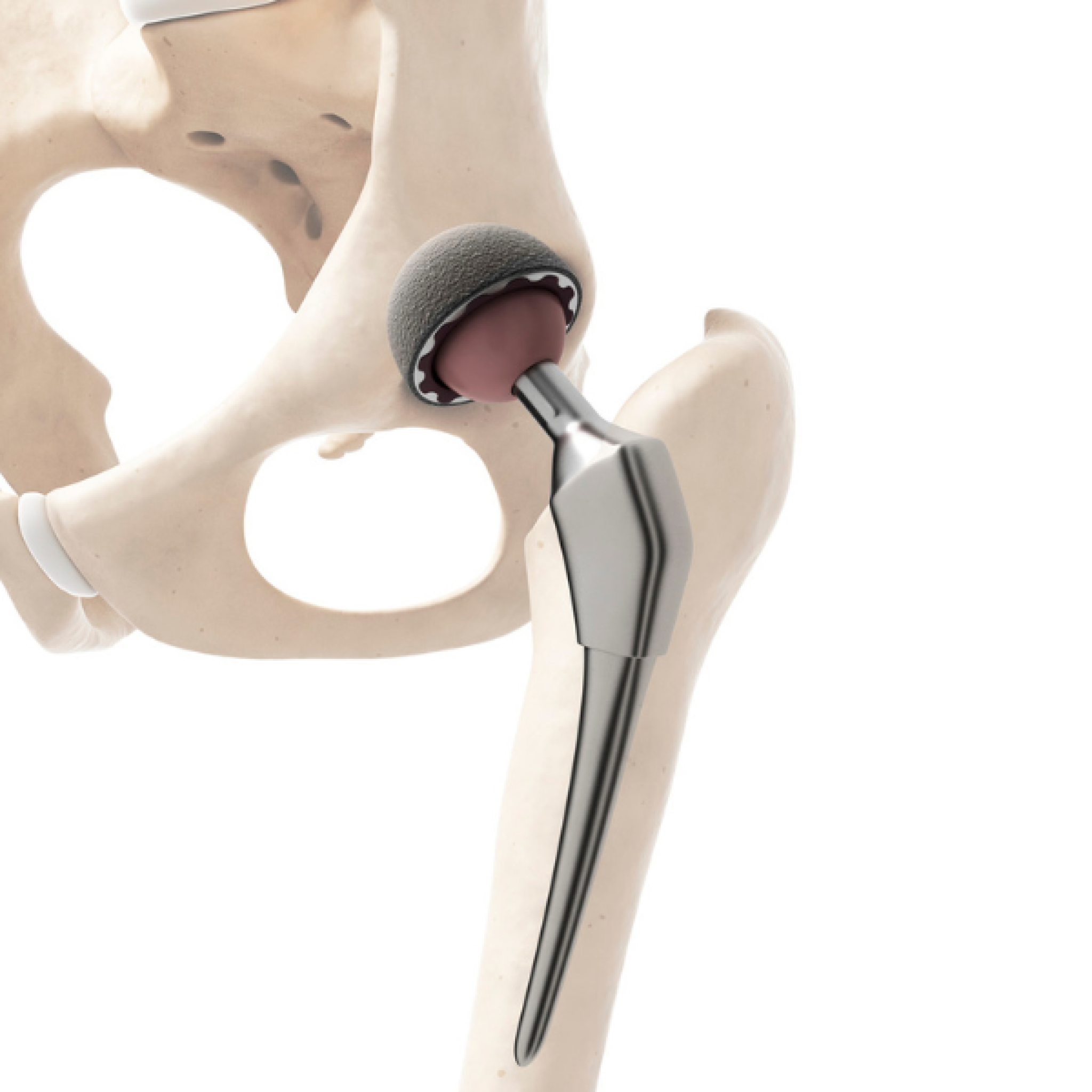 Hip Replacement Explained: A Step Towards a Pain Free Life - The Health ...