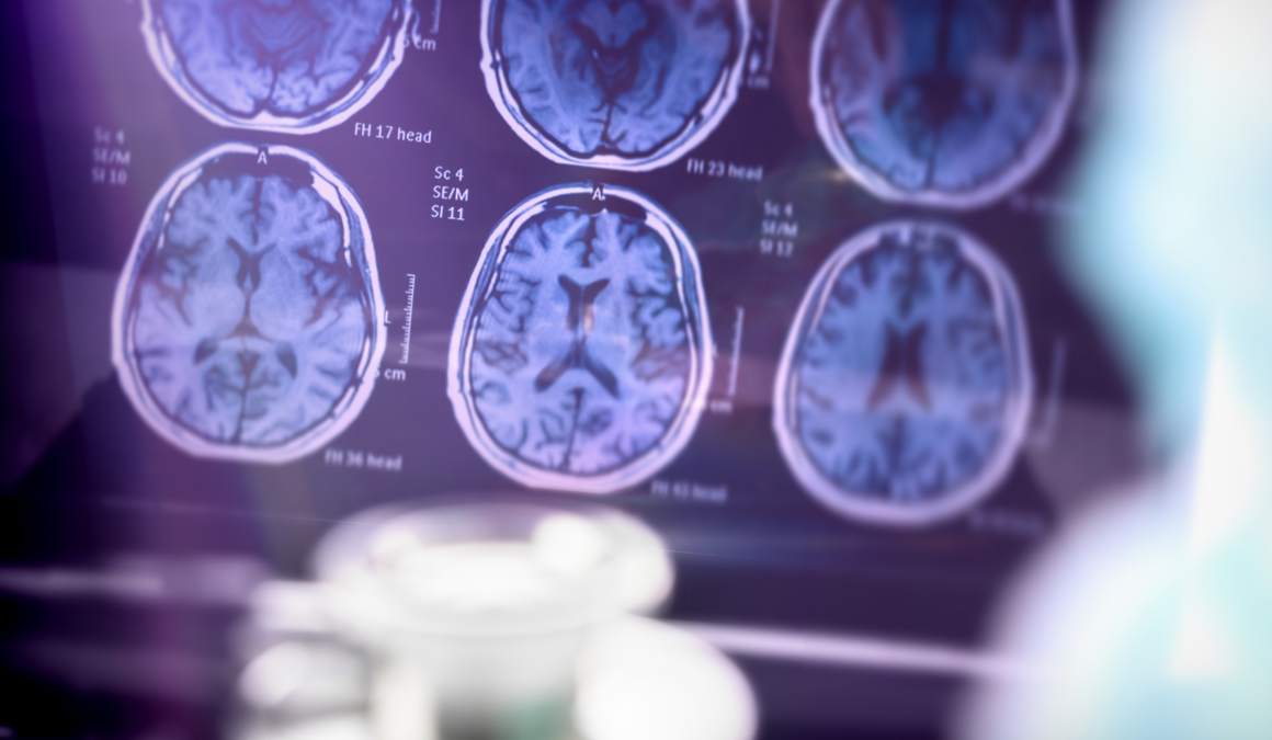Health Canada Approves New Alzheimer's Treatment Kisunla - The Health ...